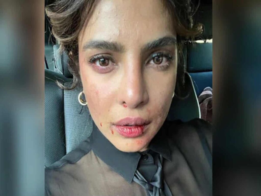 Photo of Priyanka Chopra’s injured face goes viral - The Siasat Daily ...